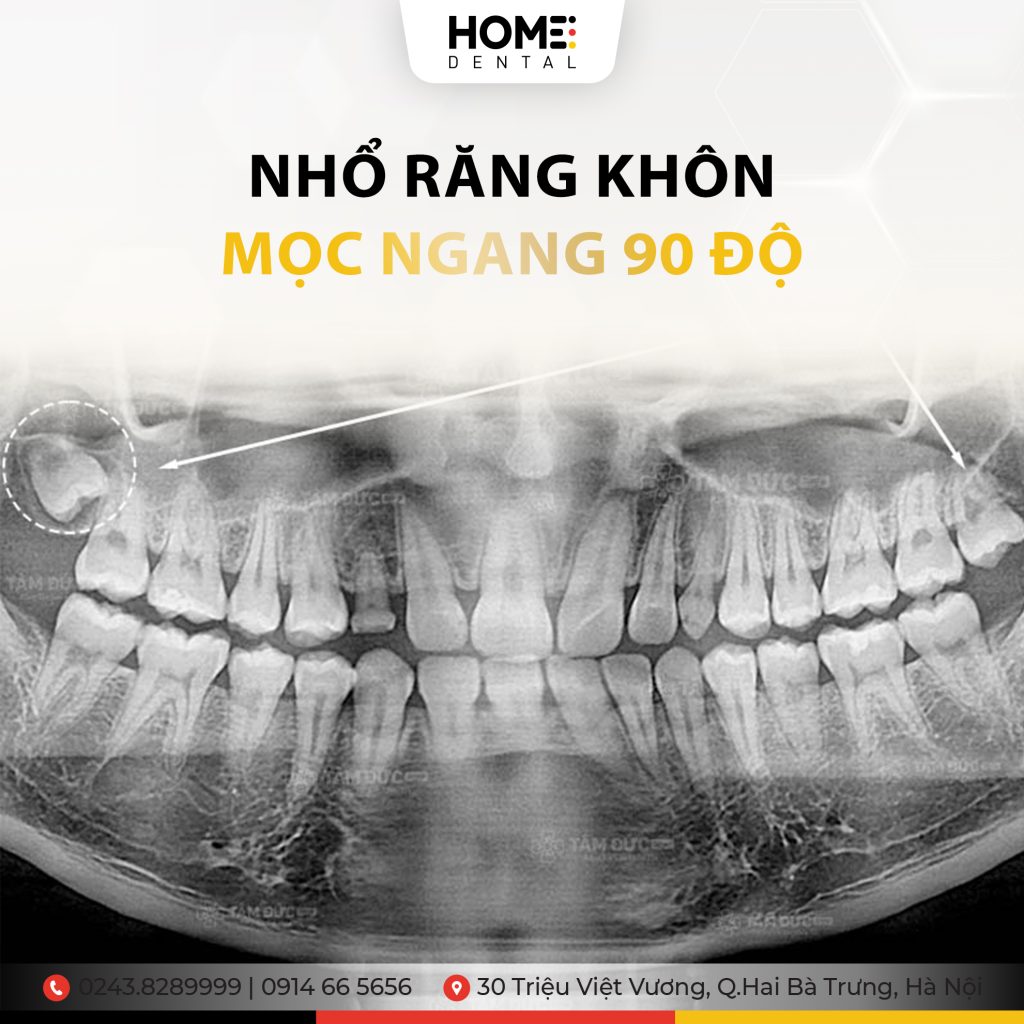 Răng Khôn Mọc Ngang: Cách nhận biết và những lưu ý